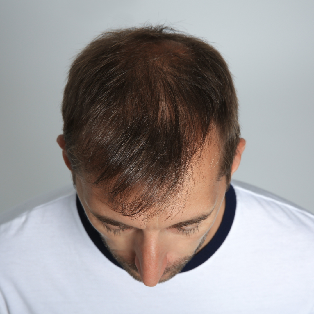 Male Pattern Thinning – Clive Hair